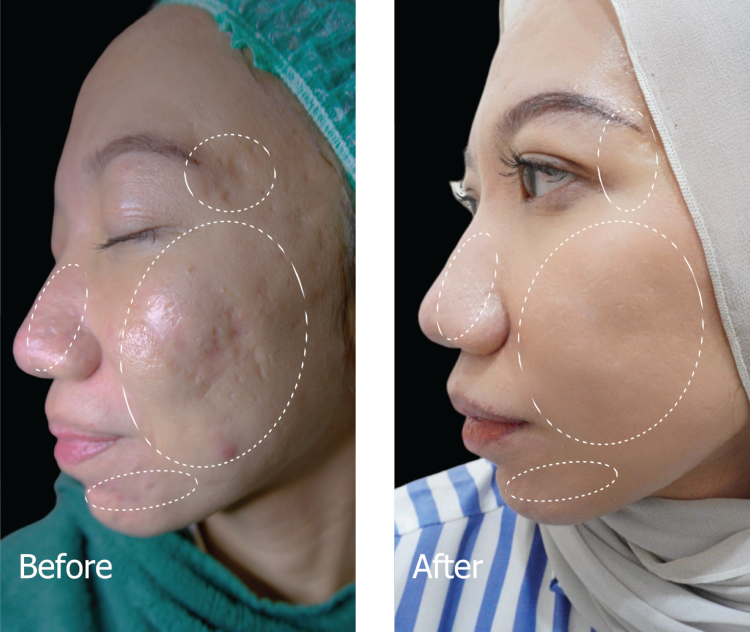 SCAR - Holistique Clinic : Indonesia Specialized Aesthetic & Wellness ...